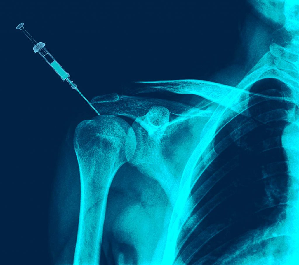 Cortisone injection, viscosupplement, PRP - Private clinic | Medvue